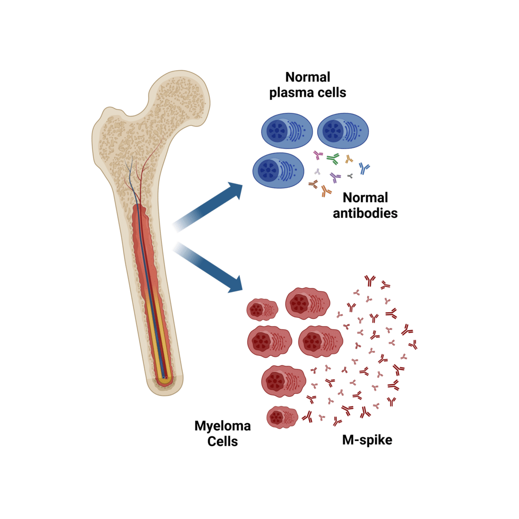 M-spike and Multiple Myeloma