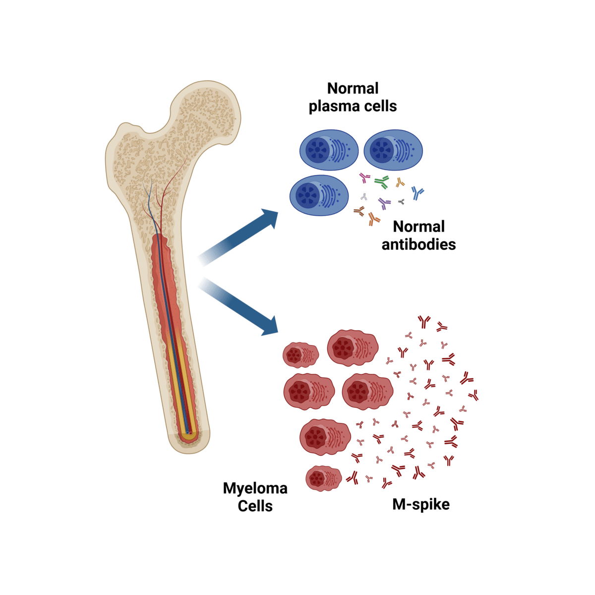 M-spike and Multiple Myeloma