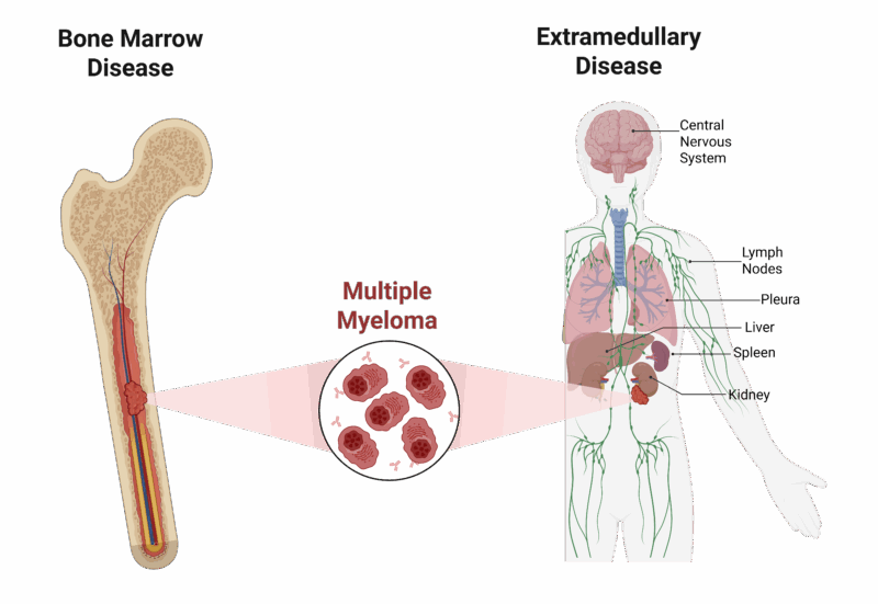 Extramedullary Disease In Multiple Myeloma